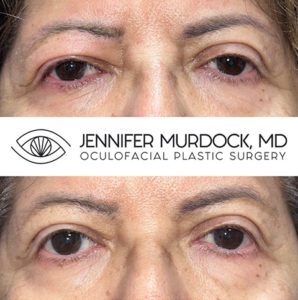 Oculoplastic Surgeon Miami | Jennifer Murdock MD