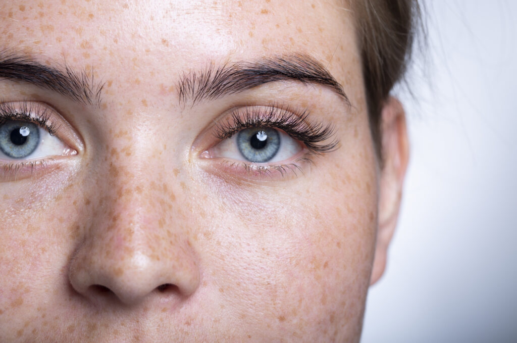 Will Eyelid Surgery Correct Eye Asymmetry? | Jennifer Murdock MD